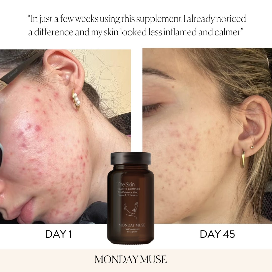 Monday Muse Clarity Complex- Hormonal Acne Supplement